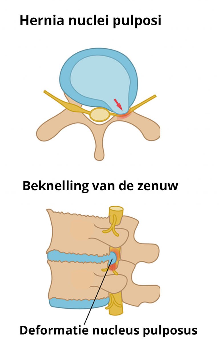Rugpijn? - Hoe een rugbrace kan helpen - Hoe je de juiste brace kiest